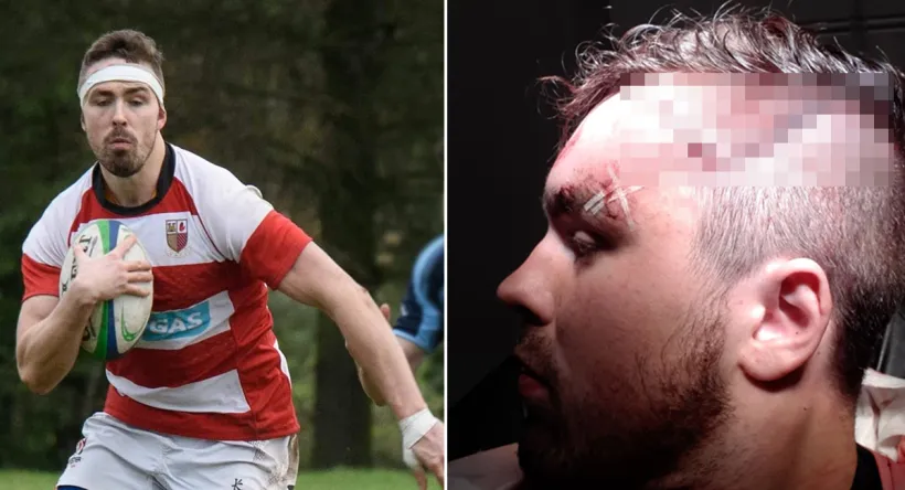 Player suffers horrific injury as boot slices through his scalp | Rugbydump