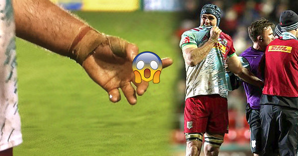 James Horwill has surgery to fix unbelievably gruesome finger injury ...
