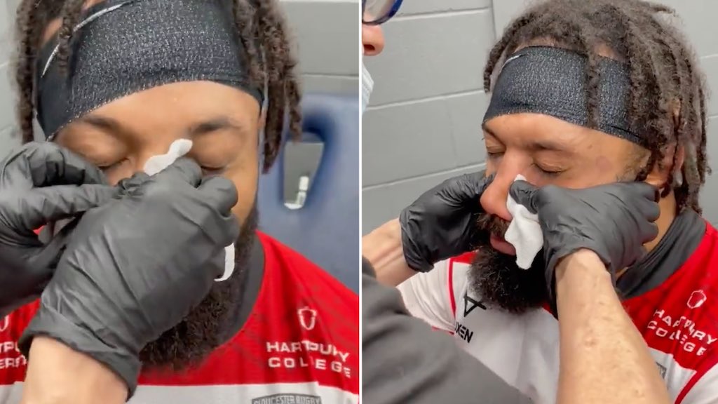 'Are you having a laugh mate!?' - Prop goes viral as broken nose is ...